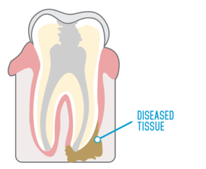 endodontic_surgery – King Endodontics
